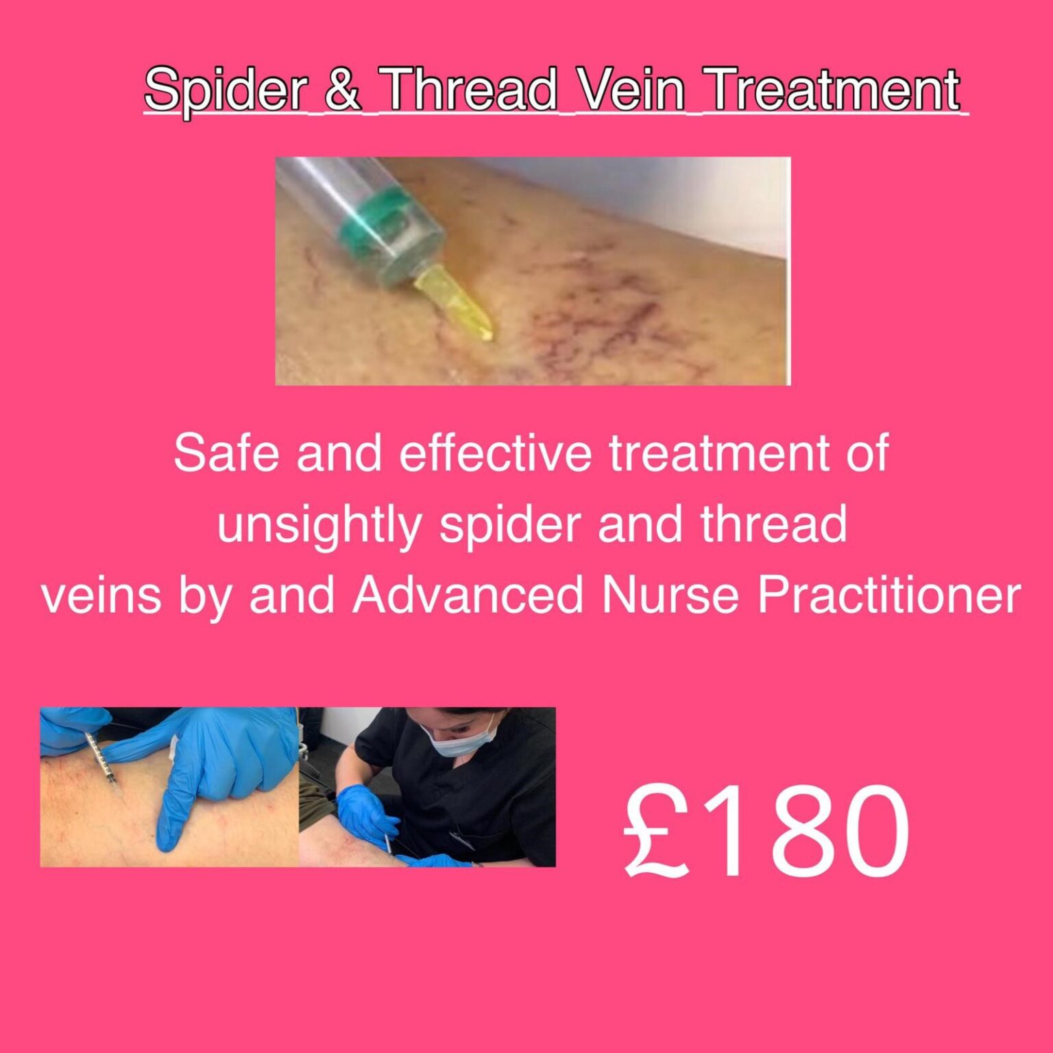 SCLEROTHERAPY- leg vein treatment - Beauty TSG